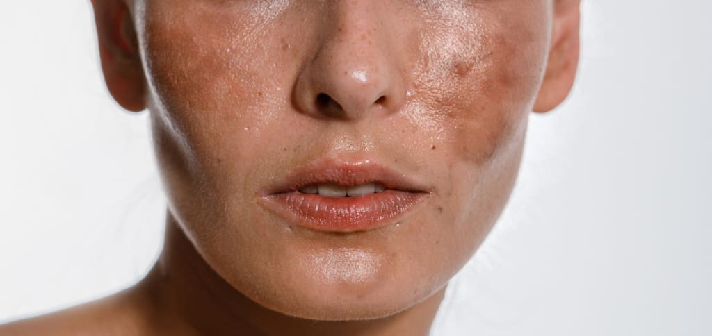 Skin Discoloration Treatment By Dermatology Experts