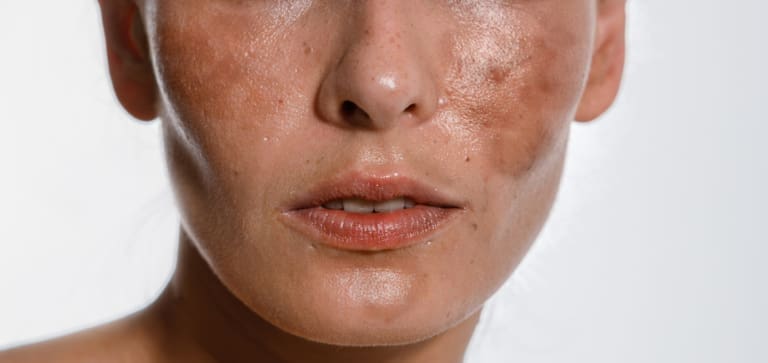 Skin Discoloration Treatment By Dermatology Experts