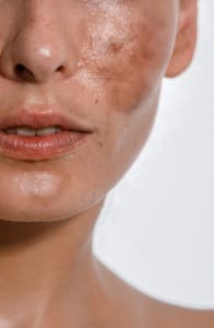 Skin Discoloration Treatment By Dermatology Experts