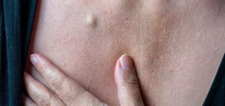Effective Sebaceous Cysts Treatment At The Day Clinic