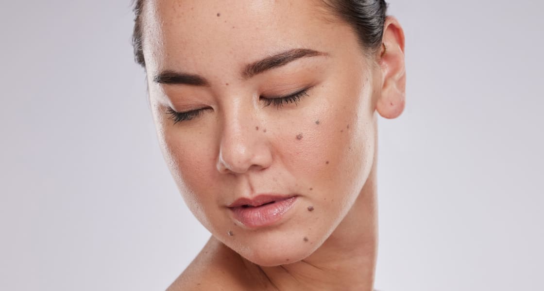 Skin Discoloration Treatment By Dermatology Experts