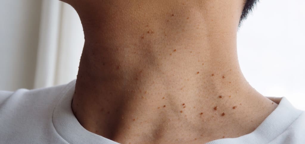 Expert Shave Excision Treatment in Cambridge | The Day Clinic