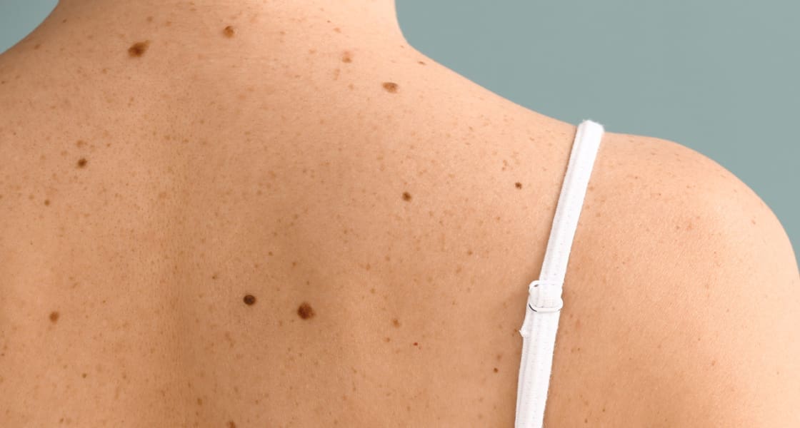 Skin Cancer | Conditions | The Day Clinic